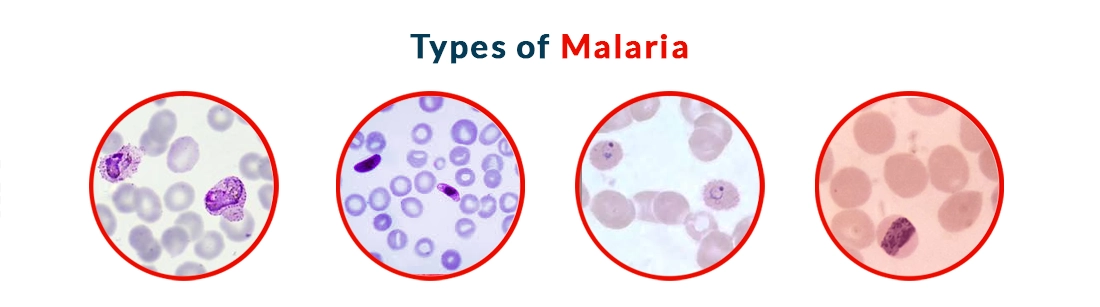 What Are the 4 Types of Malaria? | Ganesh Diagnostic